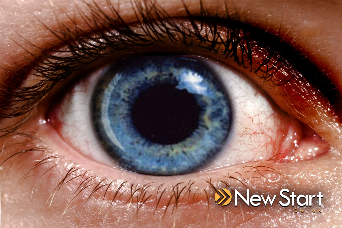 2 Ways Narcotics Hijack the Human Pupil - New Start Recovery